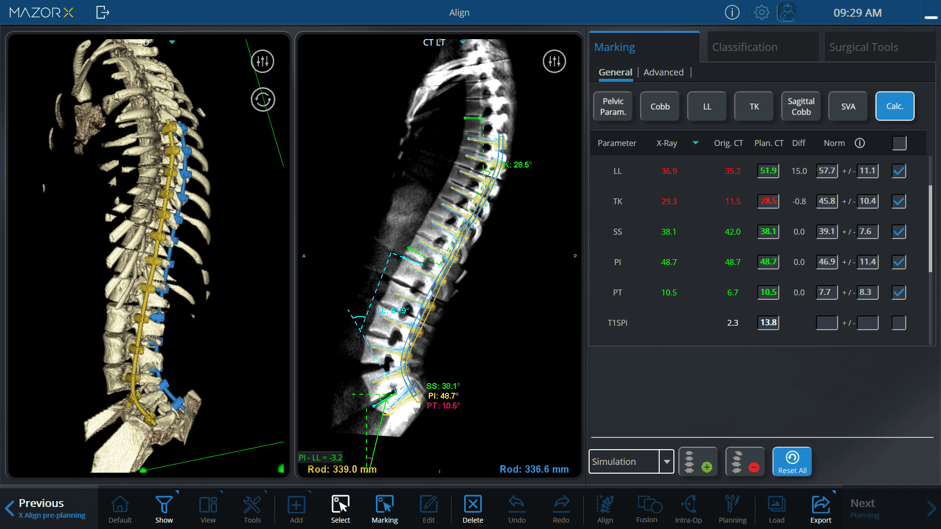 Mazor XStealth Spine Robotic Guidance | Hospital in Mountain Home, AR